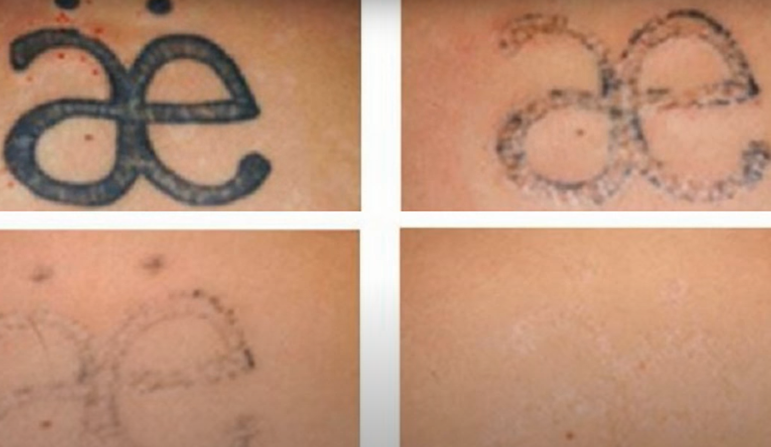 How to Fade a Tattoo? - TattooProfy